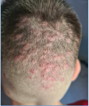 Foliculitis pustulosa eosinofílica de la infancia