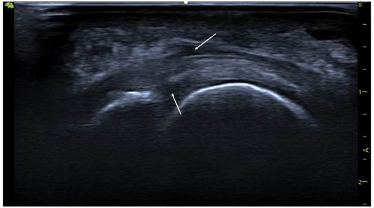 Anatomía y sonopatología de la placa plantar metatarsofalángica