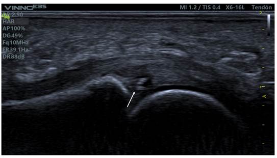 Anatomía y sonopatología de la placa plantar metatarsofalángica