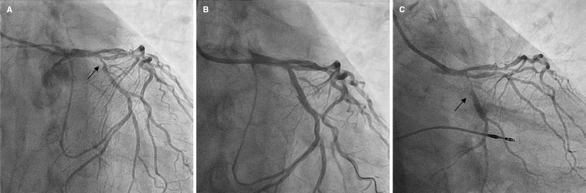 Long-term effectiveness of drug-coated balloon in the side branch ...