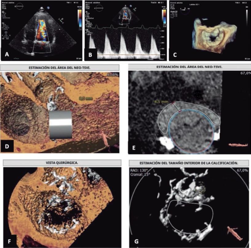 Implante de valve-in-MAC transfemoral en estenosis mitral grave por ...