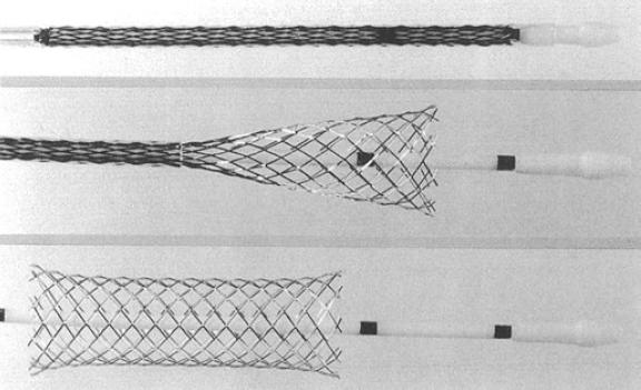 Origen del stent coronario: una historia de éxito entre científicos ...