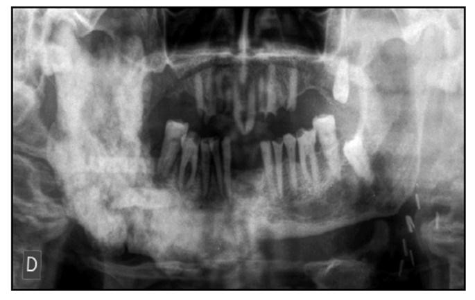 Pagets Disease Of The Jaw