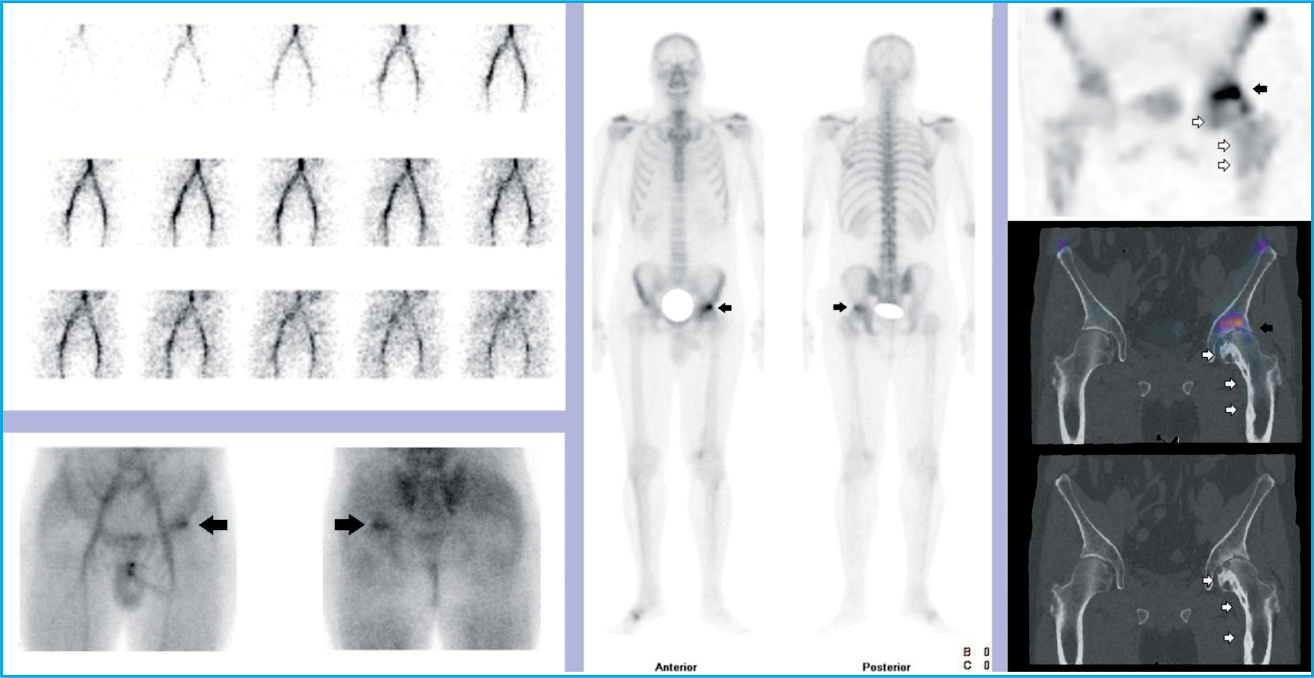 Spect Bone Scan