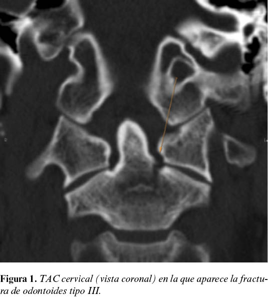 Tratamiento Multidisciplinar Del Traumatismo Cervical Con Fractura De Tratamiento Multidisciplinar Del Traumatismo Cervical Con Fractura De