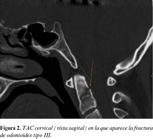 Tratamiento Multidisciplinar Del Traumatismo Cervical Con Fractura De Tratamiento Multidisciplinar Del Traumatismo Cervical Con Fractura De