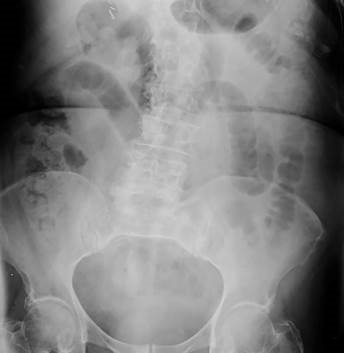 Dolor abdominal inespecífico, un cuadro a vigilar