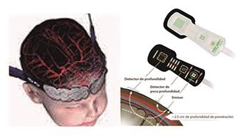 Actualización en el manejo de la hipertensión intracraneal tras un ...